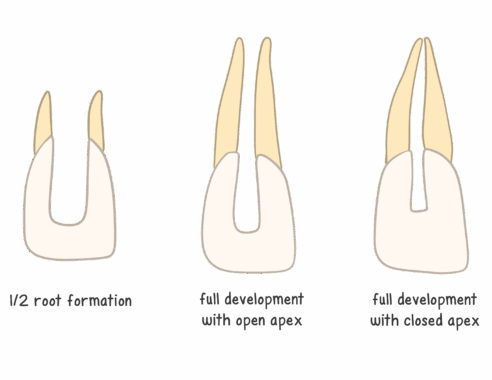 Pulpotomy vs. Pulpectomy - My Dental Key
