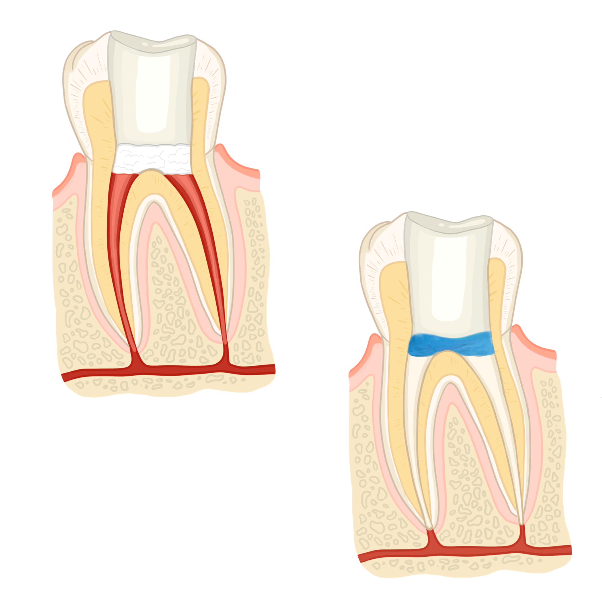 Pulpotomy vs. Pulpectomy - My Dental Key