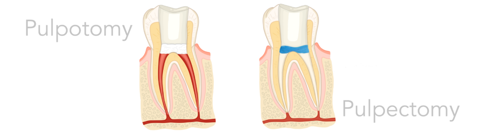 Pulpotomy vs. Pulpectomy - My Dental Key