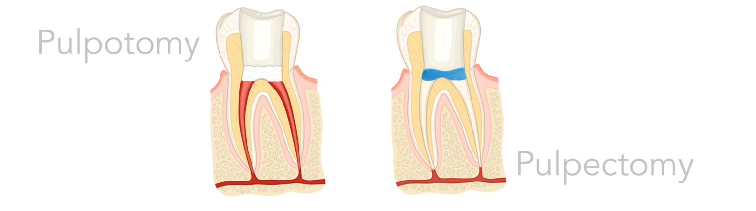 Pulpotomy vs. Pulpectomy - My Dental Key