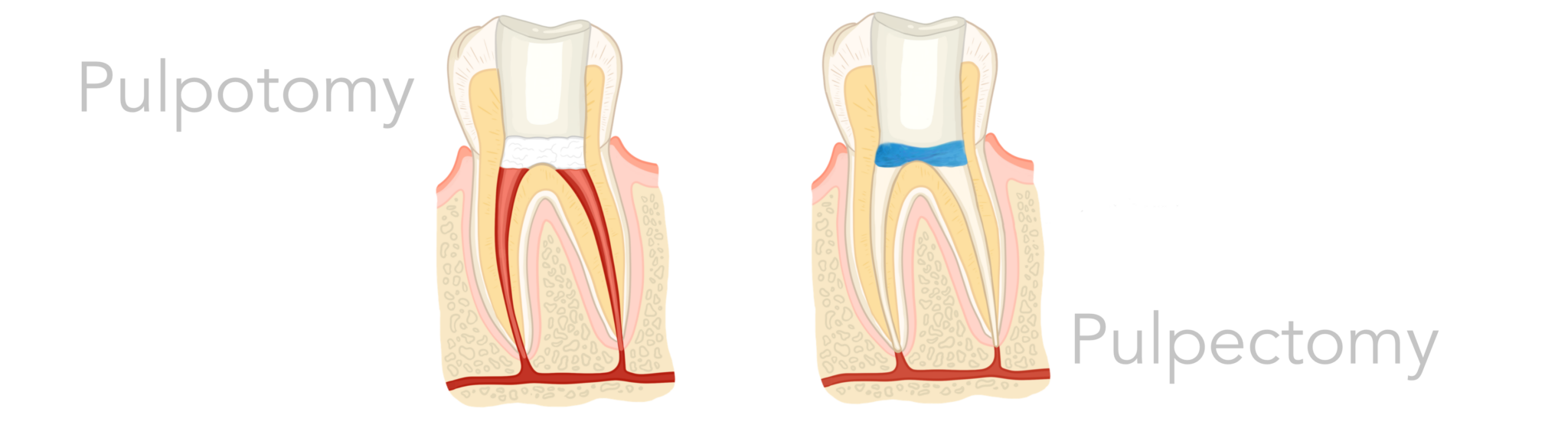Pulpotomy vs. Pulpectomy - My Dental Key