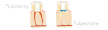 Pulpotomy vs. Pulpectomy - My Dental Key