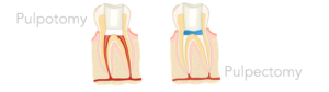 Pulpotomy vs. Pulpectomy - My Dental Key