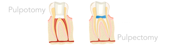Pulpotomy vs. Pulpectomy - My Dental Key