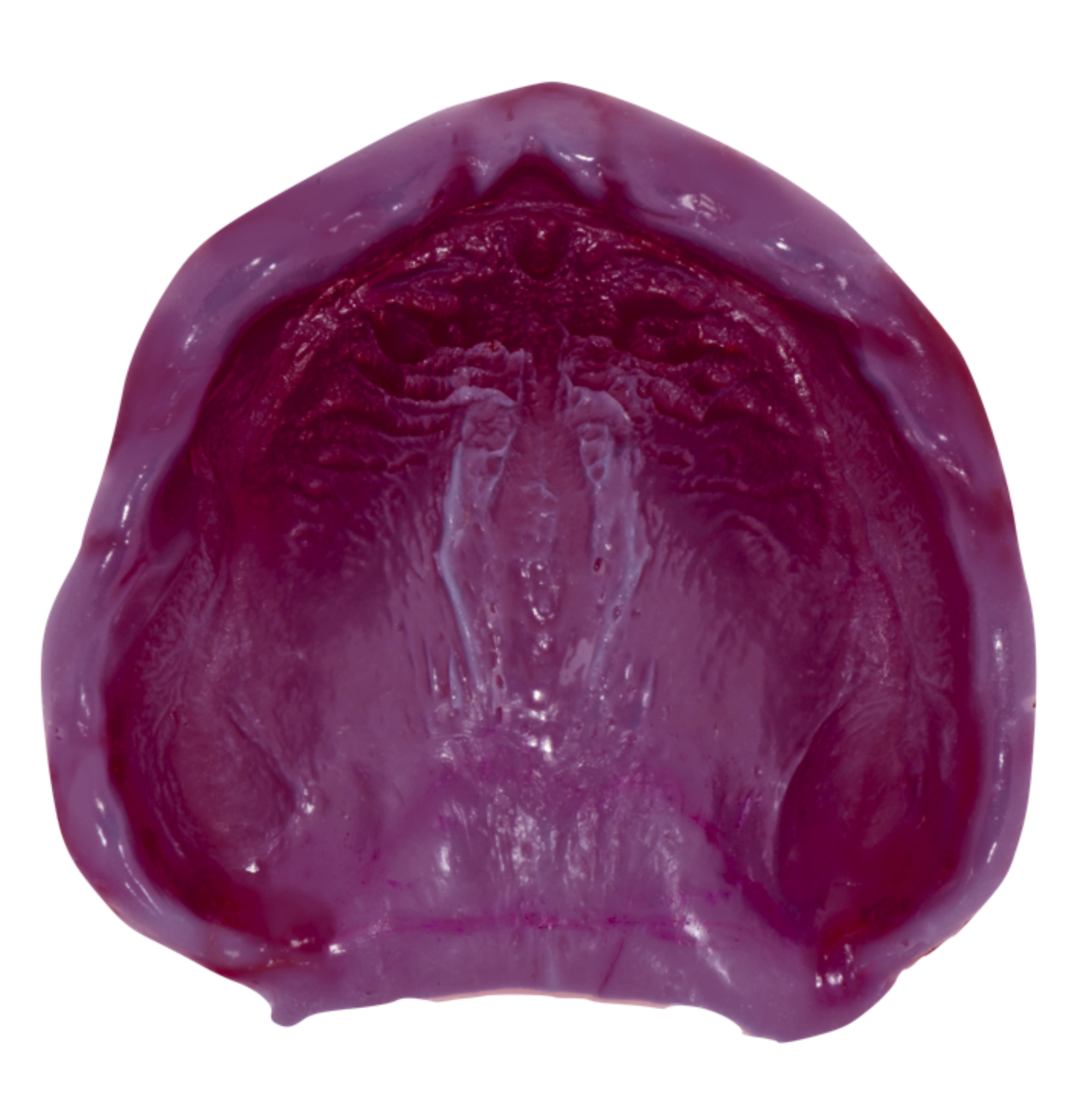 Maxillary Final Impressions - My Dental Key