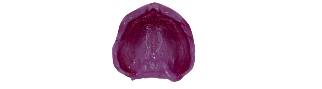 Maxillary Final Impressions - My Dental Key