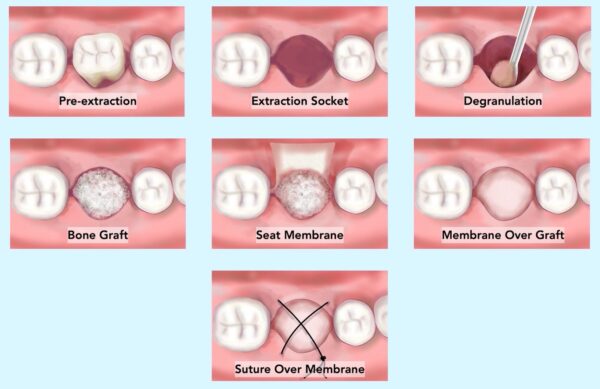 Socket Grafting Overview - My Dental Key