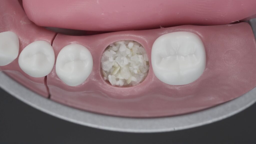 Socket Grafting Overview - My Dental Key